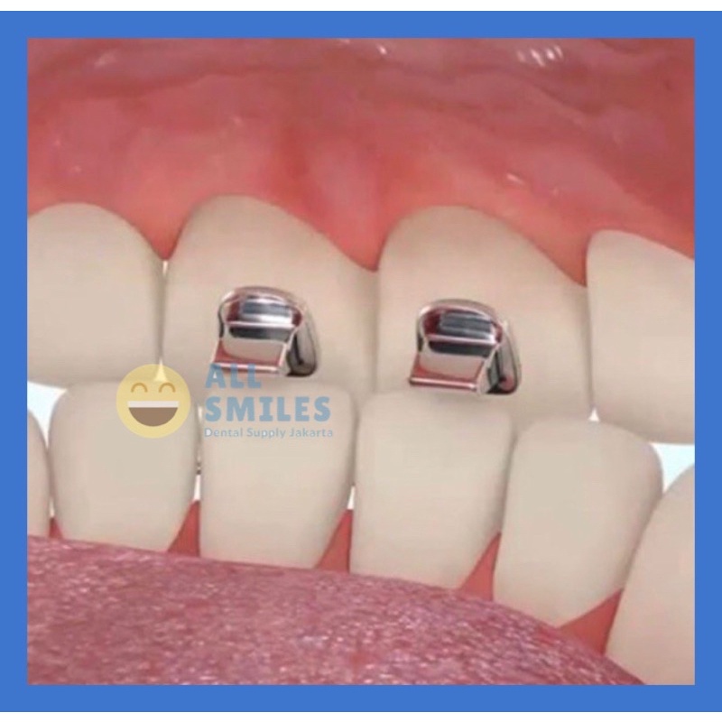 Jual bite turbo bite dental peninggi gigitan anterior peninggian gigit ...