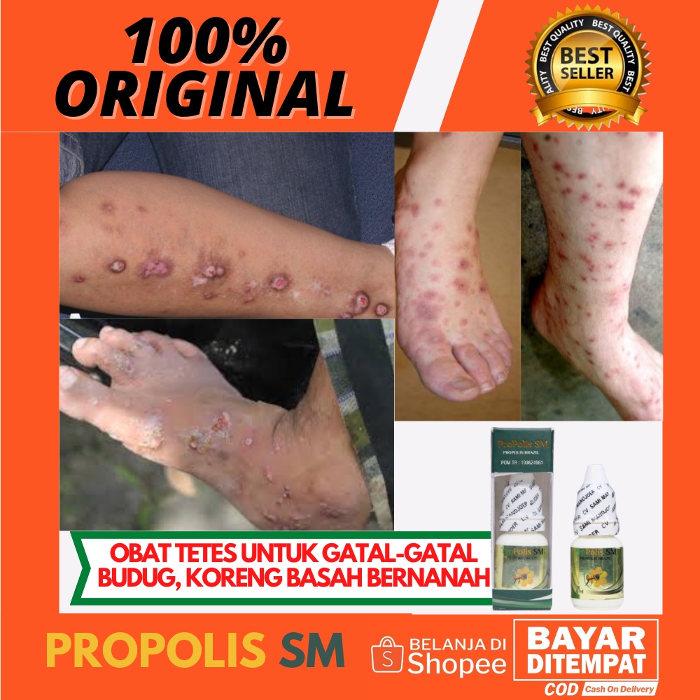 Jual Obat Koreng Budug di Kaki, Betis, Obat Gatal-gatal Jamur Kulit ...
