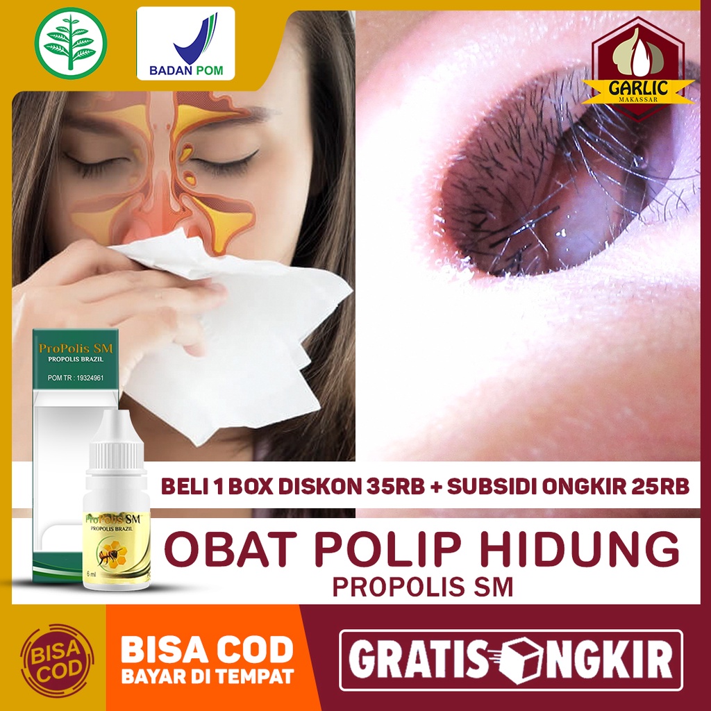 Jual Obat Polip Hidung, Sinusitis Kronis Menahun Akut, Hidung Bau Busuk ...
