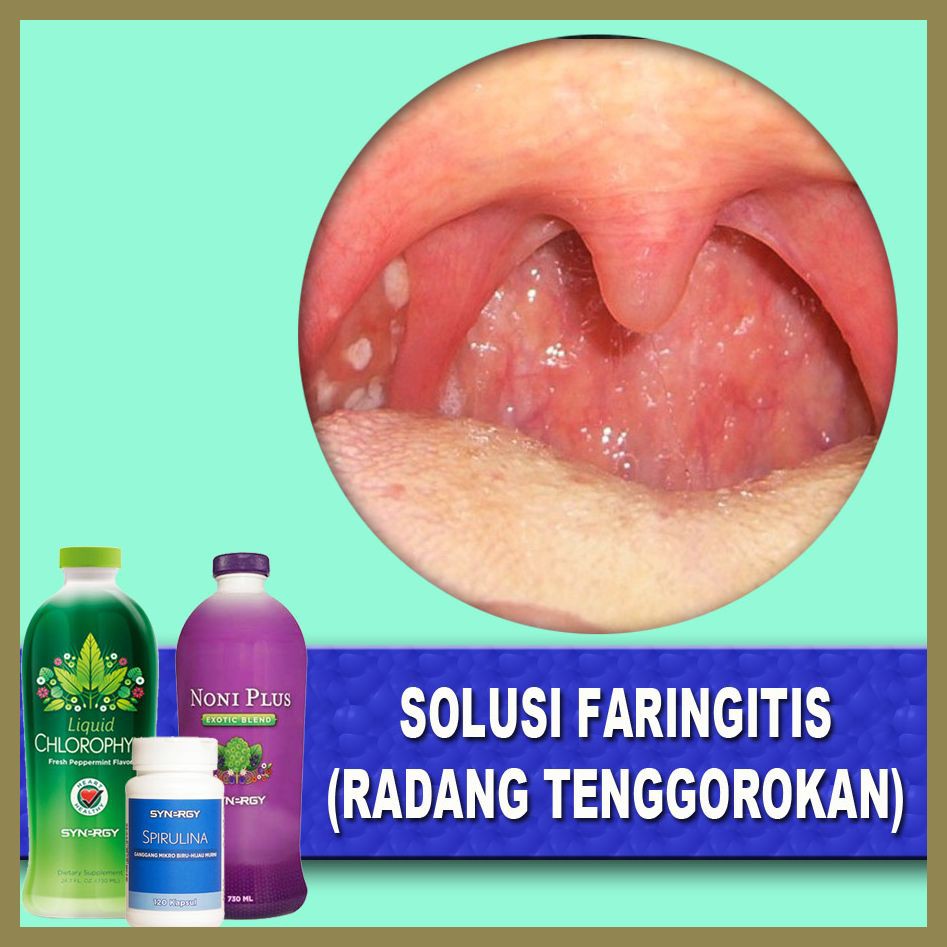 Jual Herbal Obat Radang Tenggorokan Faringitis/ Untuk Anak Dan Dewasa ...