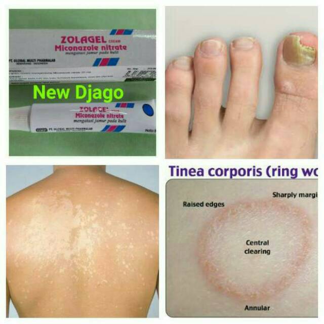 Jual ZOLAGEL CREAM - krim Jamur kuku dan kulit - Panu - kadas - kurap ...