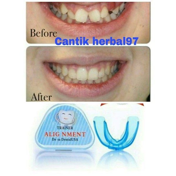 Jual Alat Perapi Gigi Behel merapikan gigi teeth retainer dewasa ...
