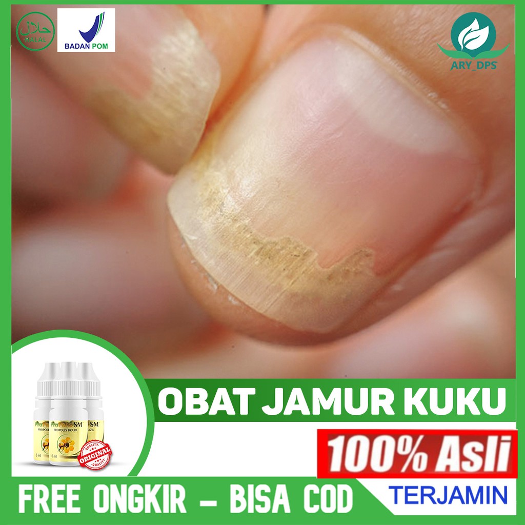 Jual Obat Jamur Kuku Tangan Kaki - Infeksi Kuku Berjamur Herbal Alami ...