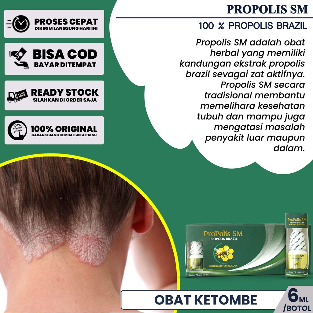 Jual Obat ketombe Kerak Kulit Kepala - Obat Oles Ketombe Parah Gatal Gatel Bersisik Psoriasis ...