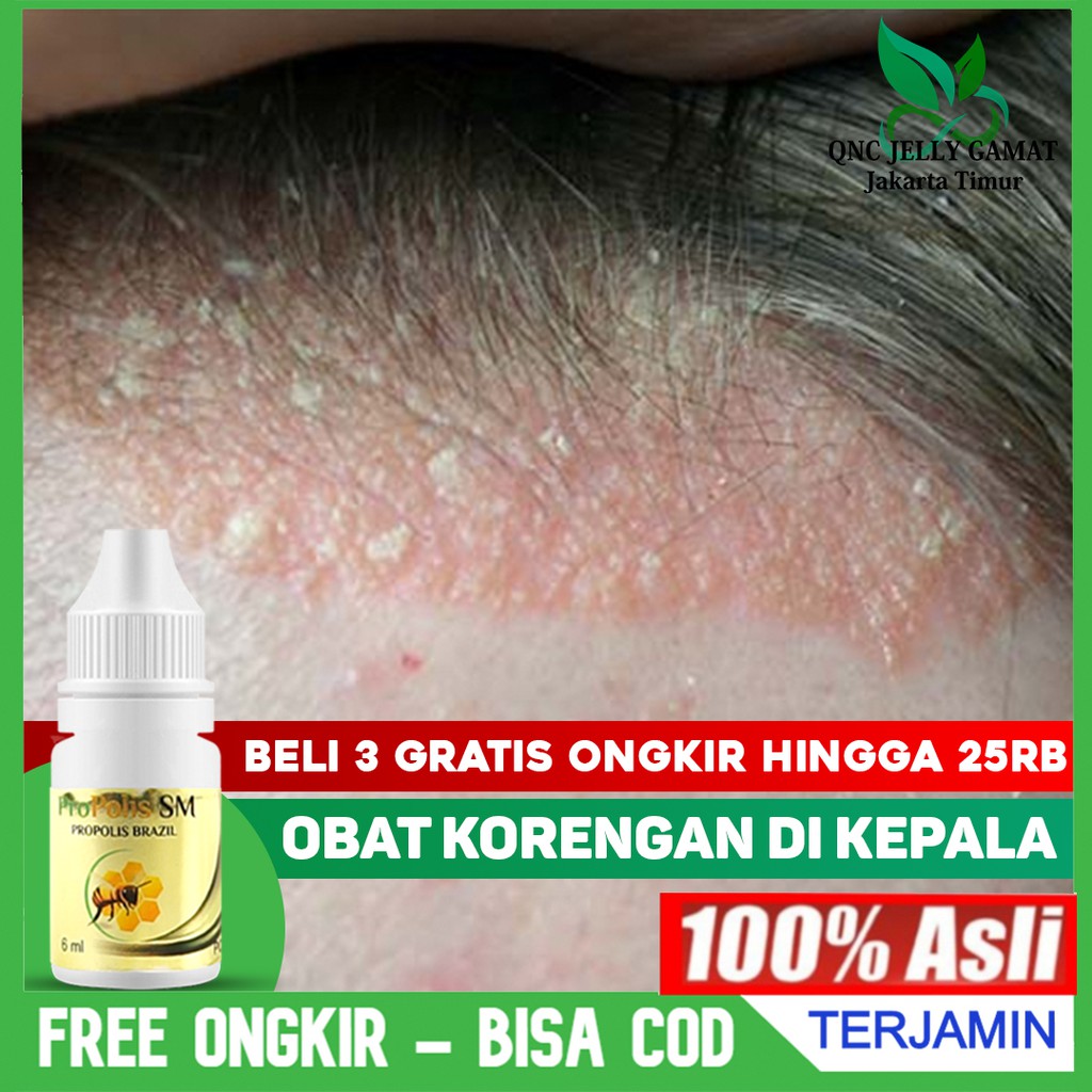 Jual Obat Korengan Di Kepala - Di Kaki - Koreng Bernanah - Luka Budug ...