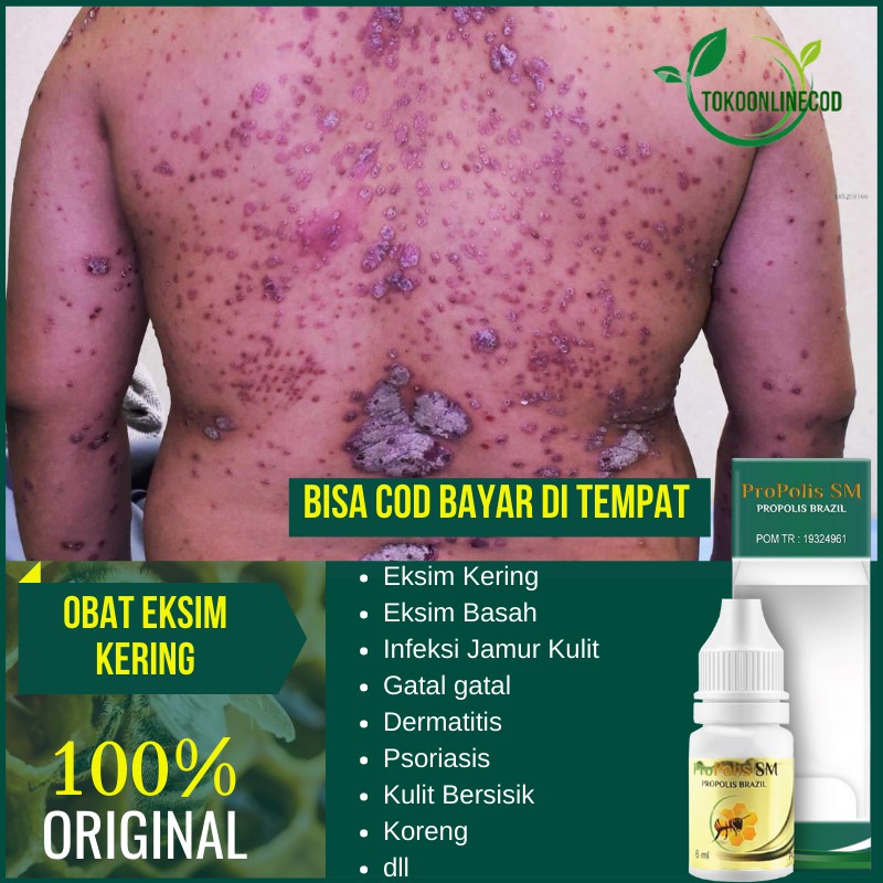 Jual Obat Eksim Kering Basah Menahun Scabies Dermatitis Seboroik Gatal ...