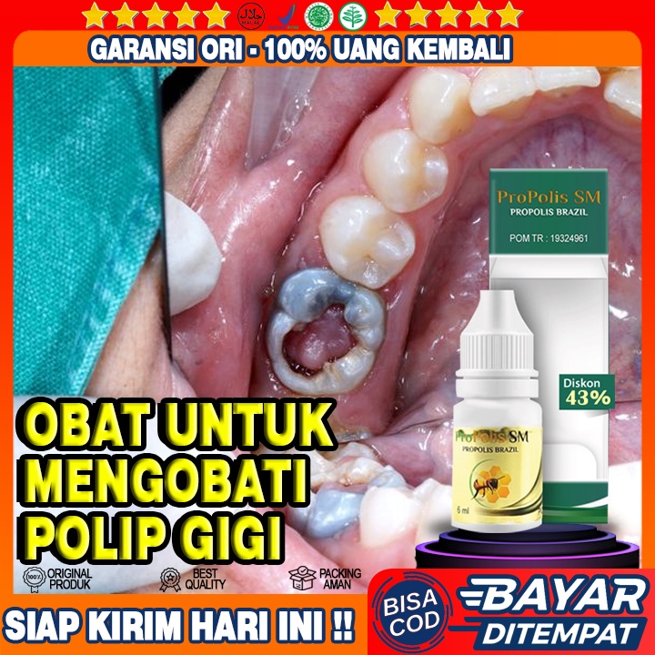 Jual Obat Polip Gigi, Obat Tetes Polip Gigi, Pengempis Benjolan Di Gigi ...