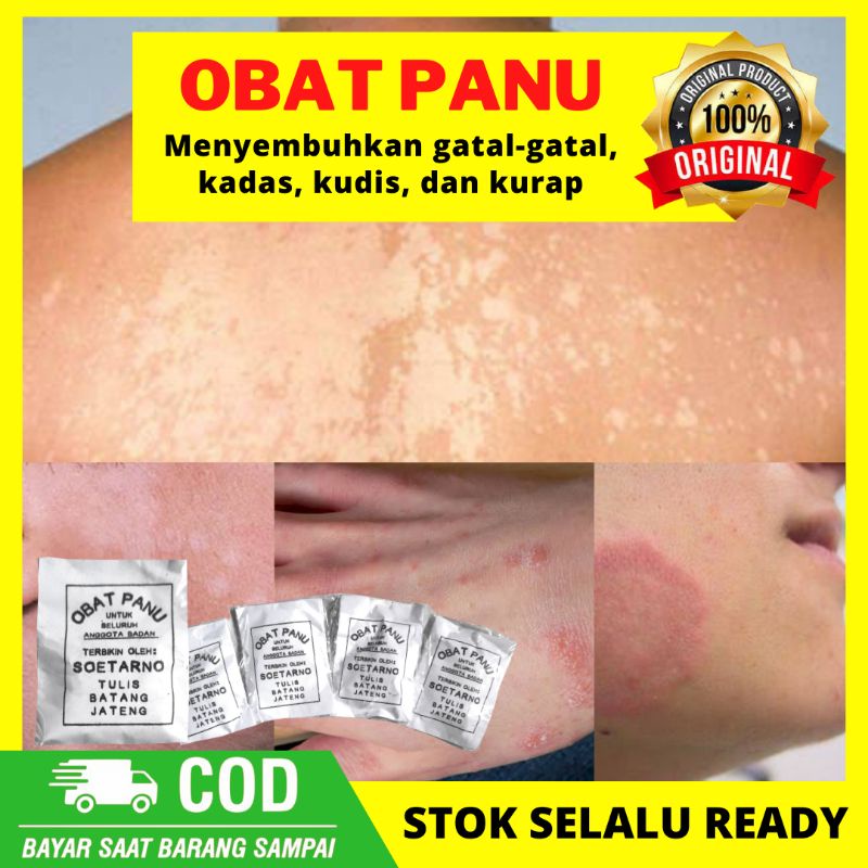 Jual Obat panu paling ampuh 100% / Obat panu tablet / Sabun panu paling ...