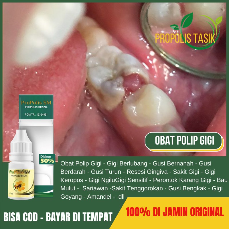 Jual Obat Polip Gigi - Polip Pulpa - Benjolan di Gigi - Daging Tumbuh ...