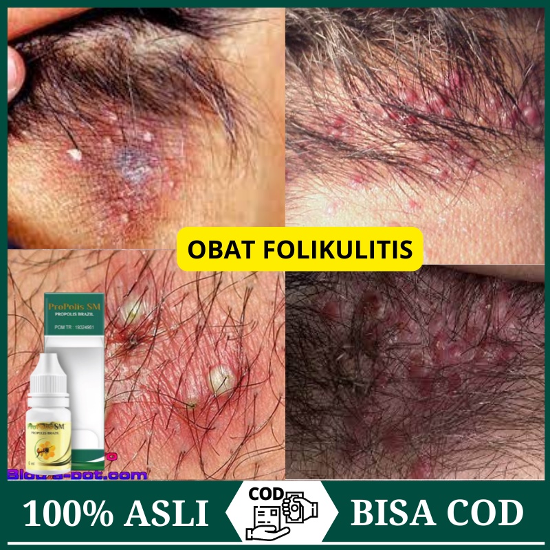 Jual Obat Folikulitis - Infeksi Jamur Di Kulit Kepala, Obat Folikulitis di Kepala / Kaki ...