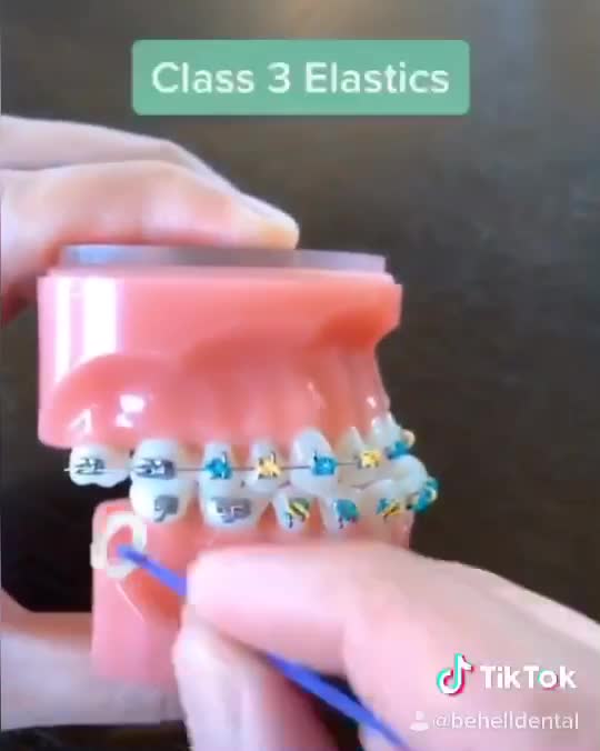 Jual 100 pics Karet Behel Elastis // Elastic Band ortho // Rubber ...