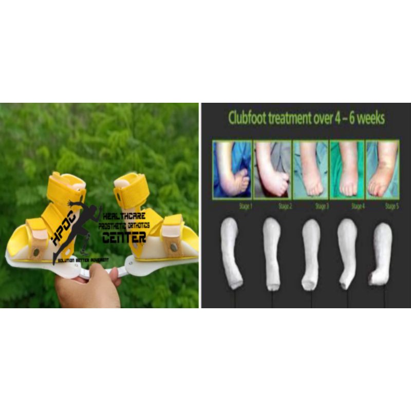 Jual sepatu koreksi kaki pengkor CTEV | Shopee Indonesia