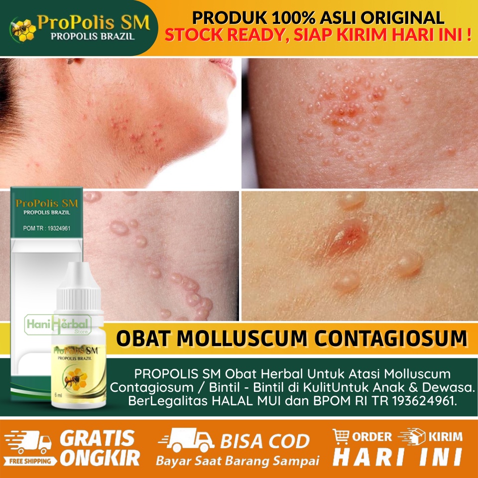Jual OBAT MOLLUSCUM CONTAGIOSUM / MOLUSKUM KONTAGIOSUM / BINTIL BINTIL ...