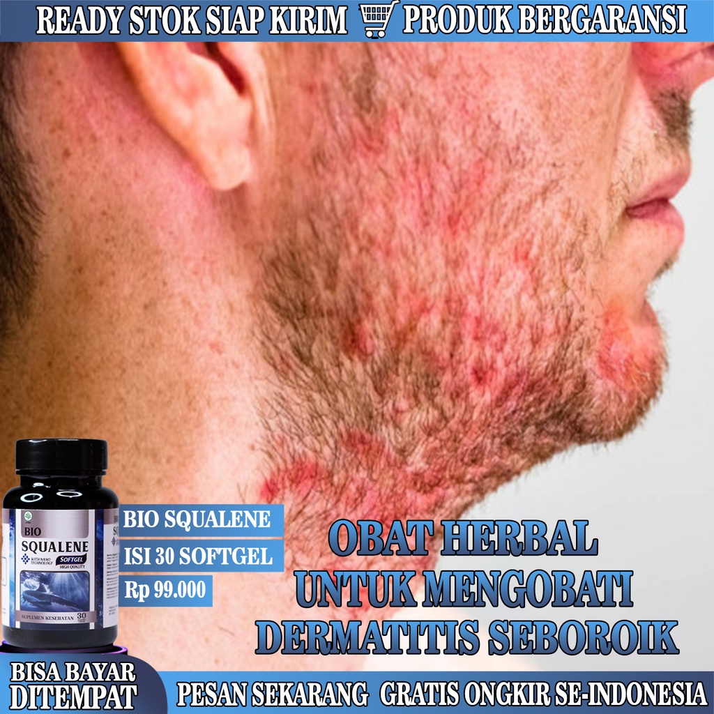 Jual Obat Untuk Dermatitis Seboroik, Kulit Kumis Dan Jenggot Bersisik ...