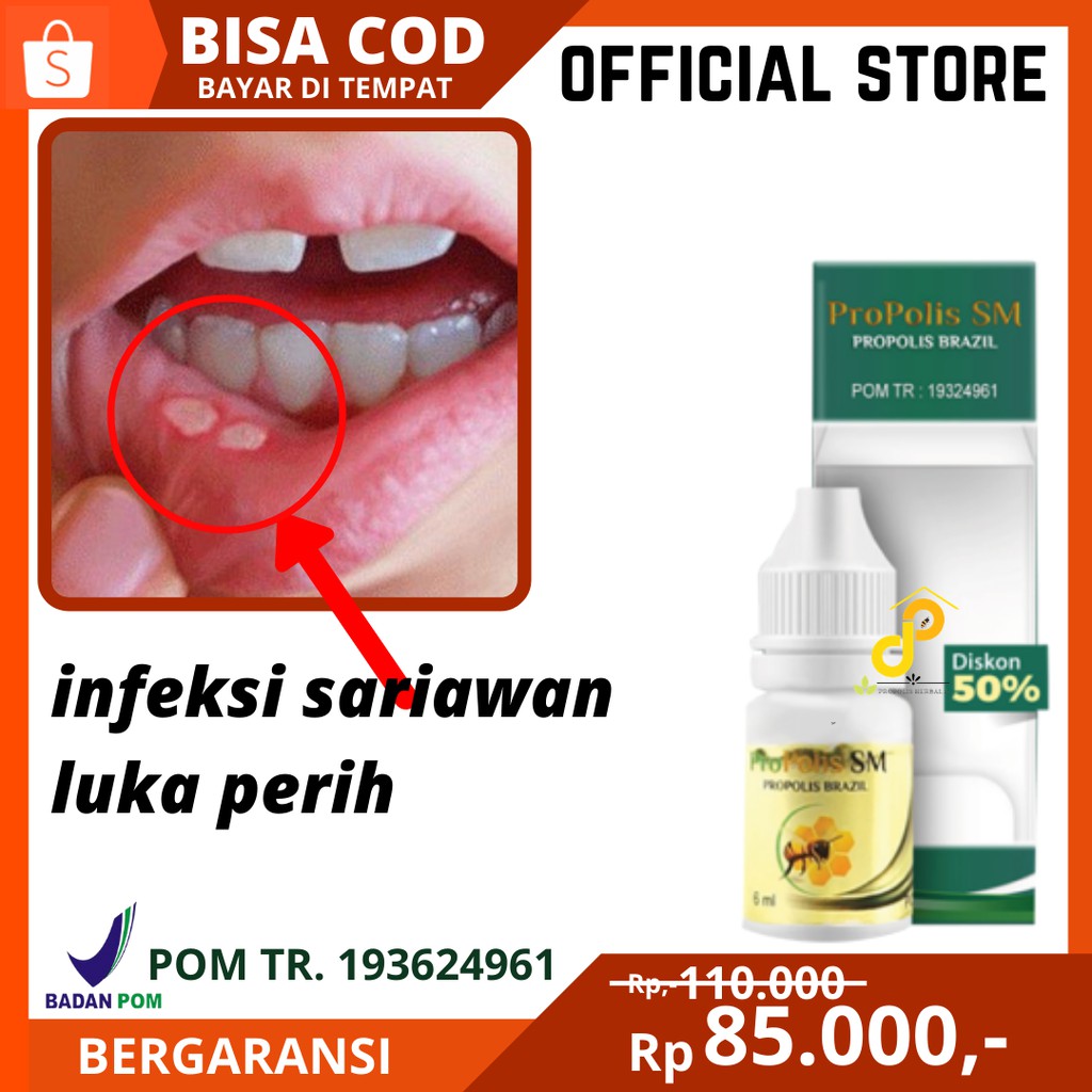 Jual Propolis SM Obat Sariawan untuk anak dan Dewasa, Infeksi Sariawan ...