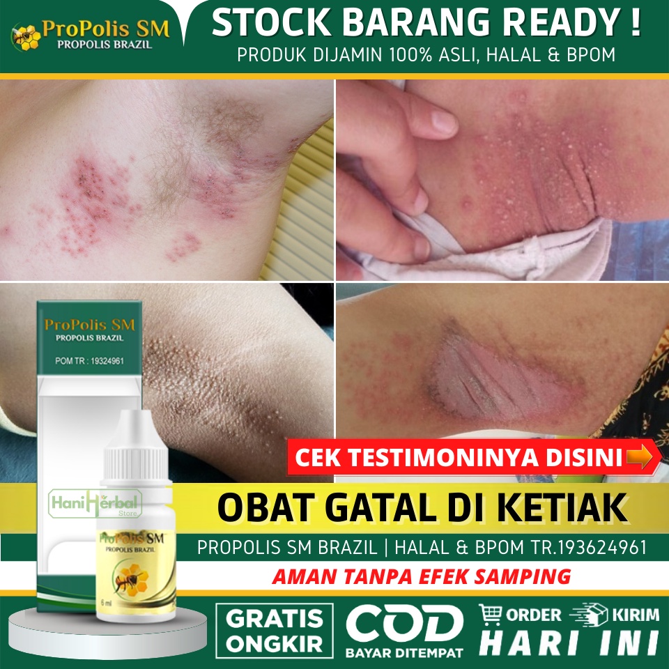 Jual Obat Gatal di Ketiak, Obat Gatal Jamur di Ketiak, Penghilang Gatal ...