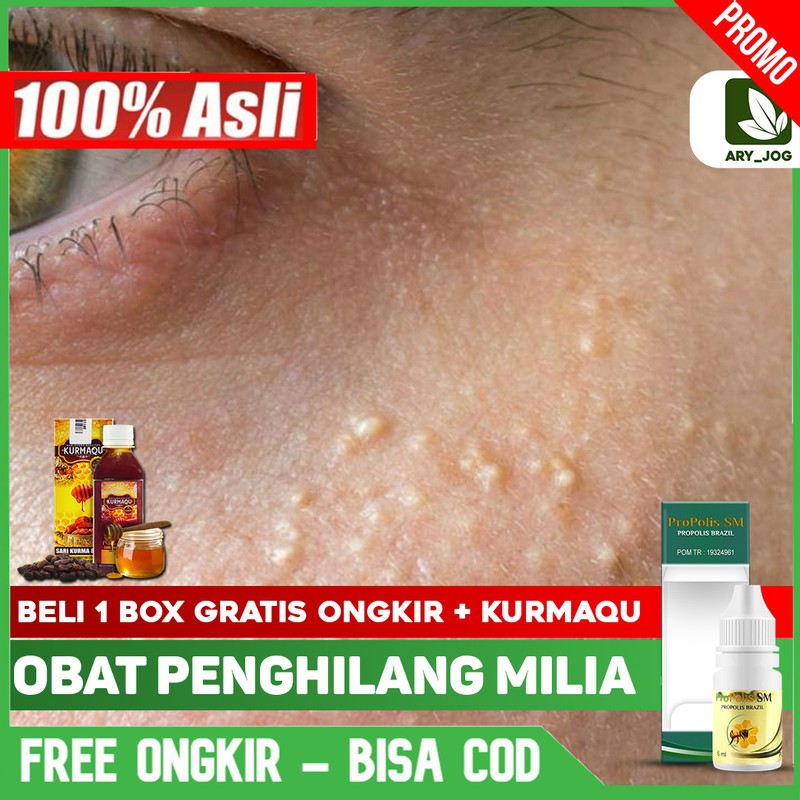 Jual Obat Penghilang Milia Di Muka, Bintik Putih Di Kelopak Mata Herbal ...