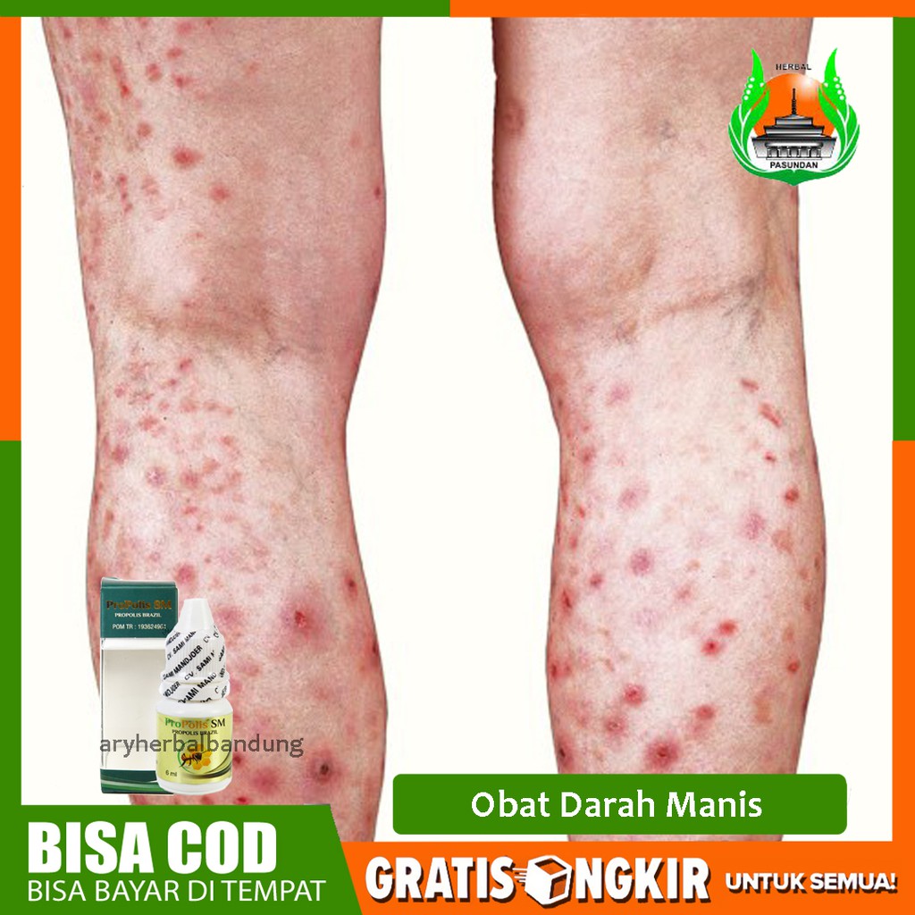 Jual Obat Darah Manis - Prurigo - Gatal-Gatal Herbal Alami Propolis SM ...