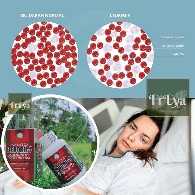 Jual OBAT LEUKEMIA, OBAT HERBAL LEUKIMIA, OBAT KANKER DARAH (BISA COD ...