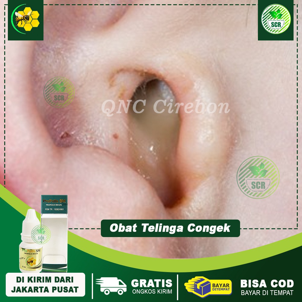 Jual Obat Congek Menahun, Telinga Berair dan Bau, Telinga Bengkak ...