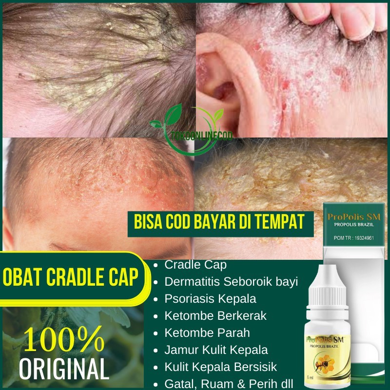 Jual Obat Cradle Cap, Dermatitis Seboroik Pada Bayi, Kulit Kepala Bersisik, Ketombe Berkerak ...