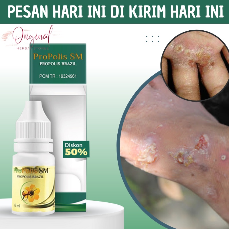 Jual Obat Gatal Budug, Obat Budug Bernanah / Scabies , Obat Budug di ...