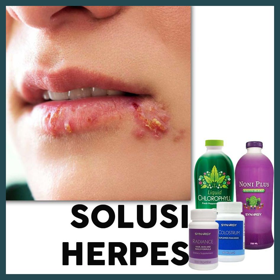 Jual PAKET HERBAL Herpes Zoster / Cacar Api Asli Nature | Shopee Indonesia