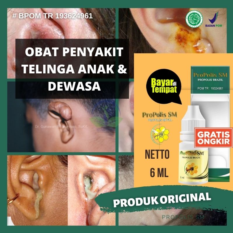 Jual OBAT TELINGA CONGEK PADA ANAK DAN DEWASA, SOLUSI OBATI PENYAKIT ...