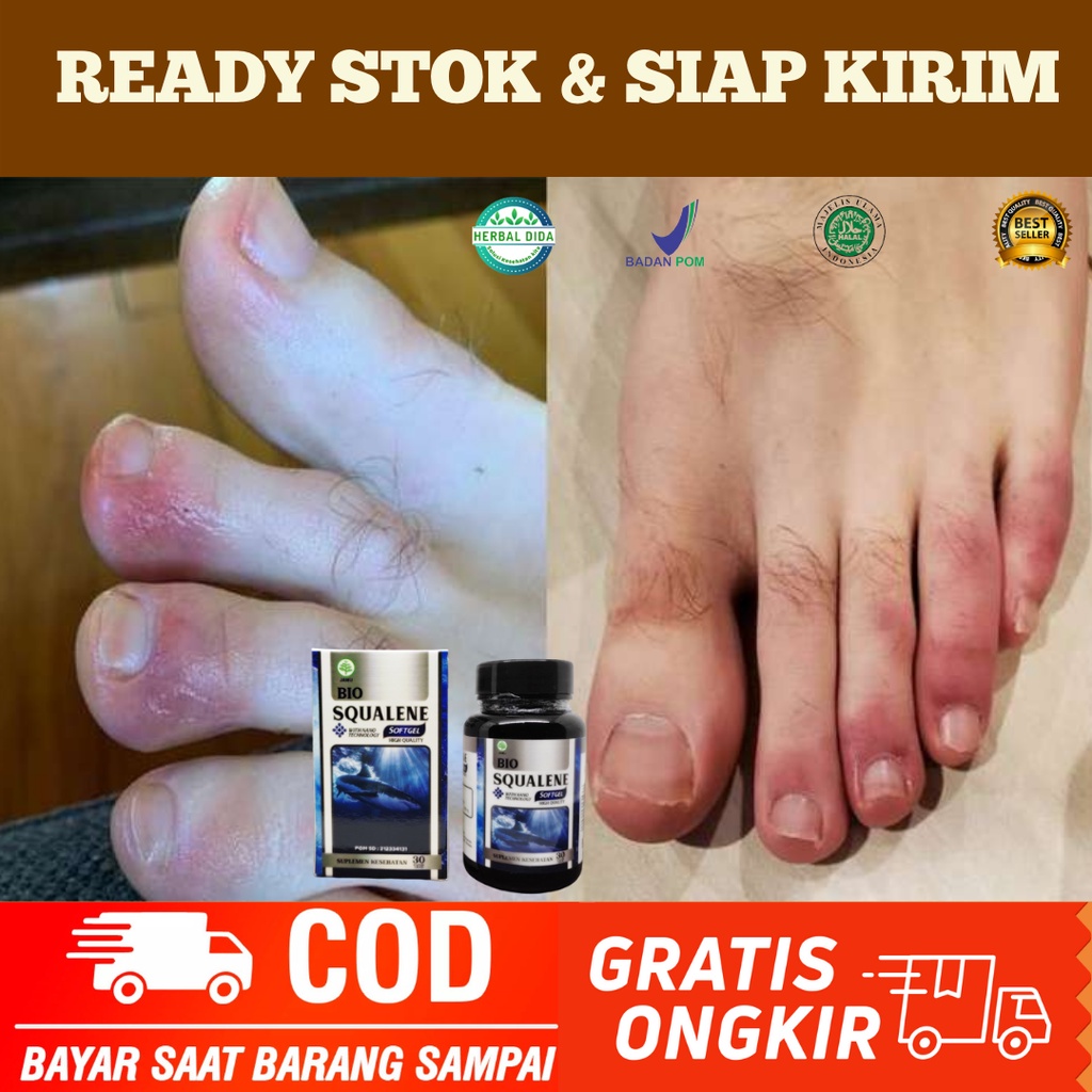 Jual Obat Kaki Bengkak Karena Ginjal, Obat Kaki Bengkak Karena Gula ... Jual Obat Kaki Bengkak Karena Ginjal, Obat Kaki Bengkak Karena Gula ...