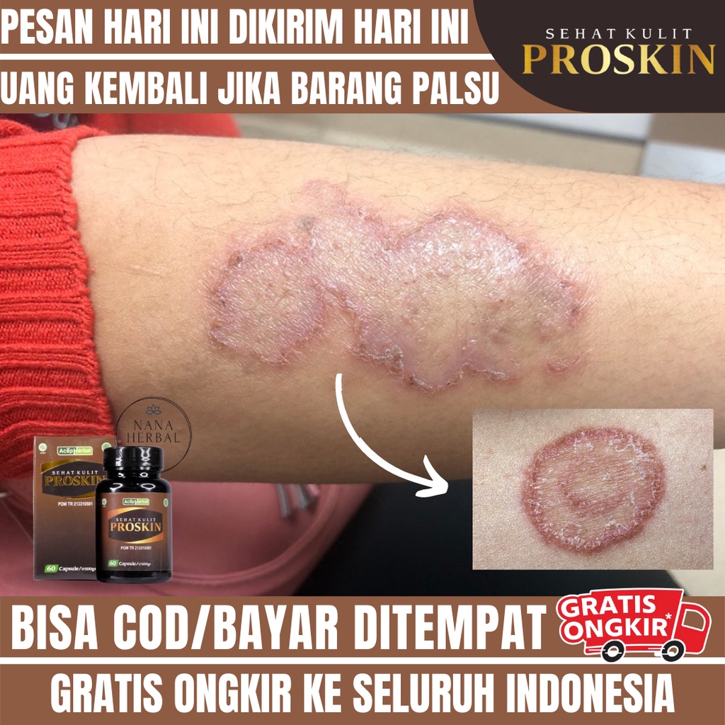 Jual Proskin Obat Herbal Infeksi Jamur Pada Kulit, Obat Antijamur Panu ...