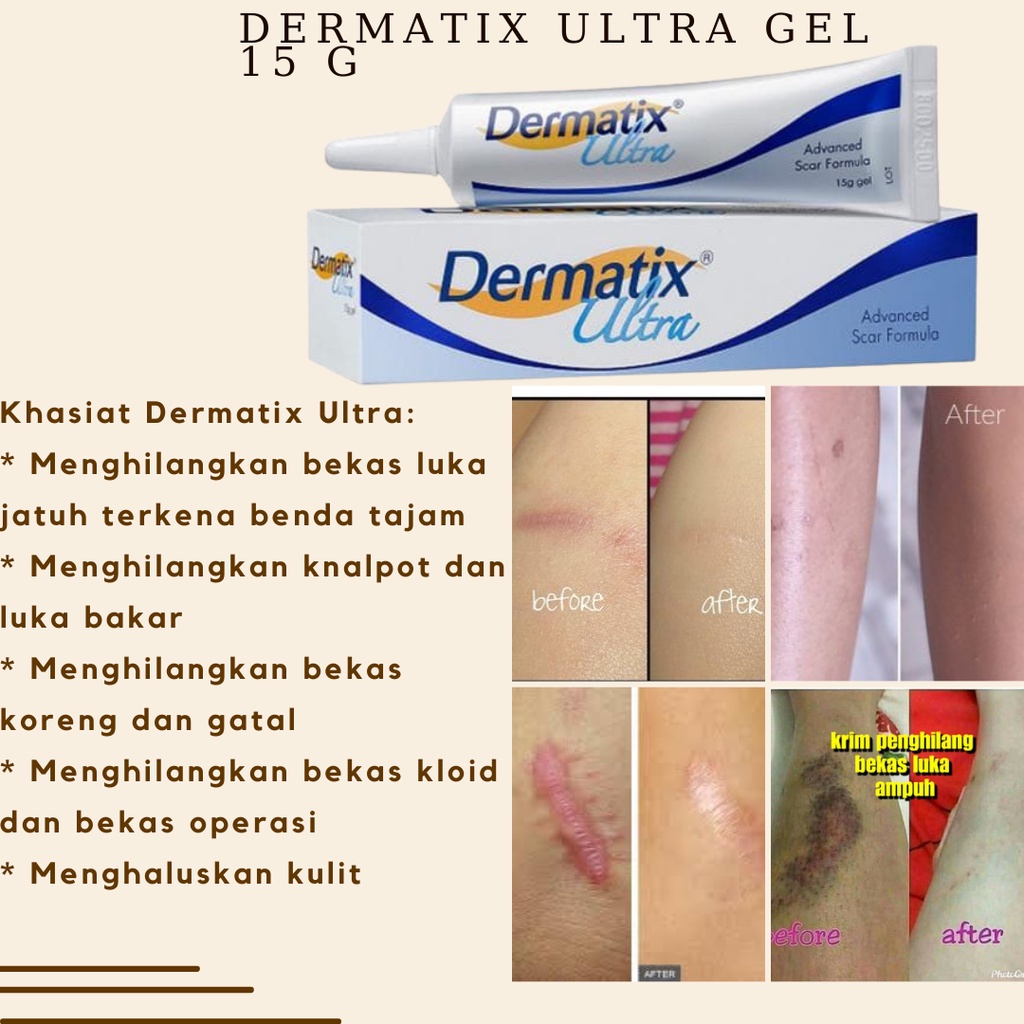 Jual Dermatix Ultra Gel 15g Salep Krim Penghilang Bekas Luka Keloid ...