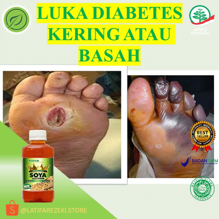 Jual Obat luka bakar diabetes kering basah koreng gatal jerawat batu ...