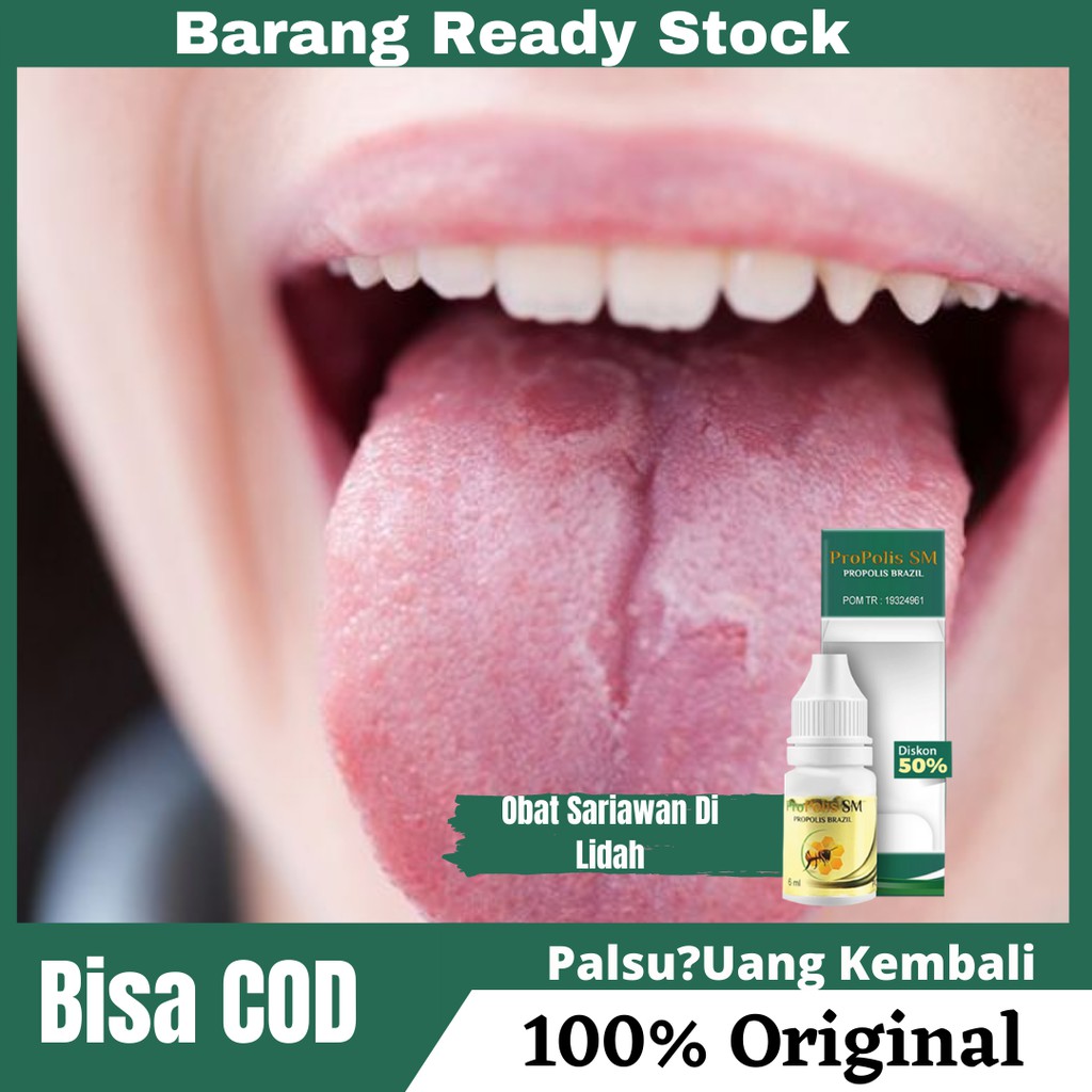Jual Obat Sariawan Lidah , Sariawan Lidah Luka , Sariawan Anak Dan ...