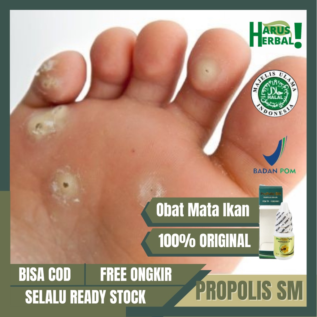 Jual Obat Oles Mata Ikan, Obat Mata Ikan Di Telapak Kaki, Di Tangan ...