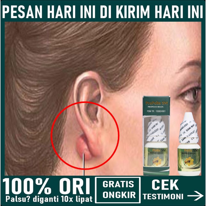 Jual Penghilang Keloid Bekas Luka Tindik - Penghilang Keloid di Telinga ...