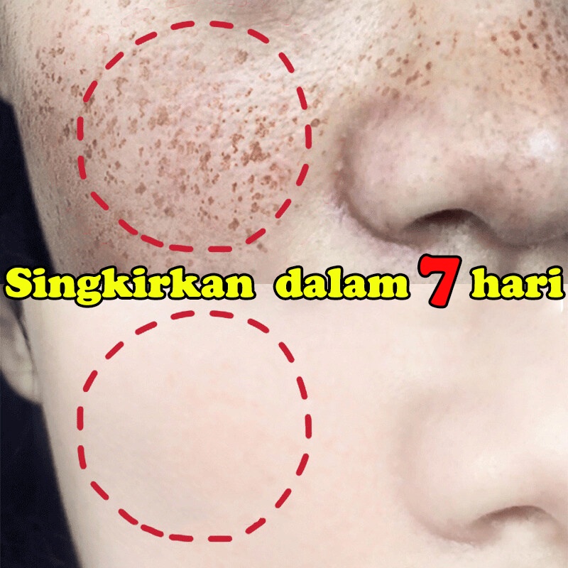 Jual HEMEIEL Singkirkan melasma dalam 7 hari /produk penghilang noda ...