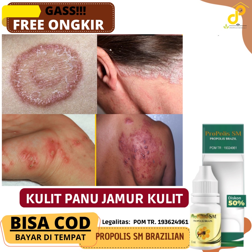 Jual PROPOLIS CAIR / SEBAGAI PENGGANTI KALPANAK ORIGINAL OBAT KULIT ...