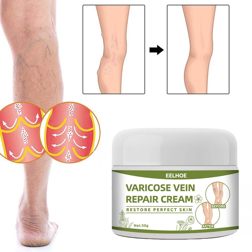 Jual PREORDER EELHOE Krim Perawatan Varises Vaskulitis Flebitis Spider ...