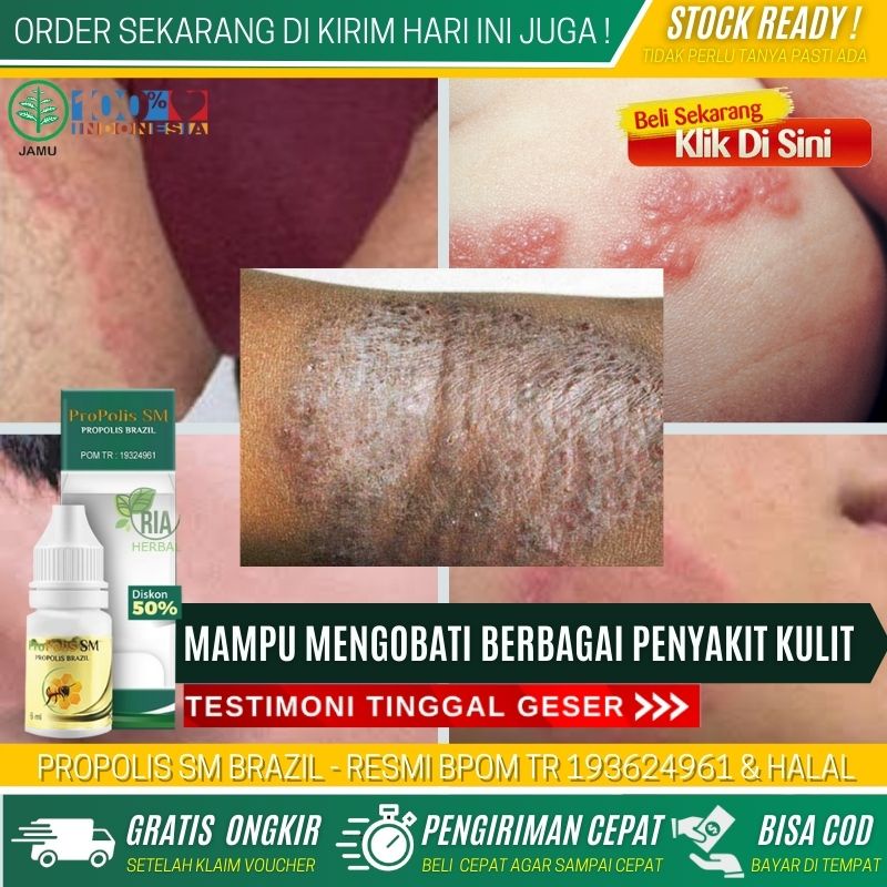 Jual Obat Koreng di Kaki, Penghilang Budug Dan Gatal Pada Kaki, Scabies ...