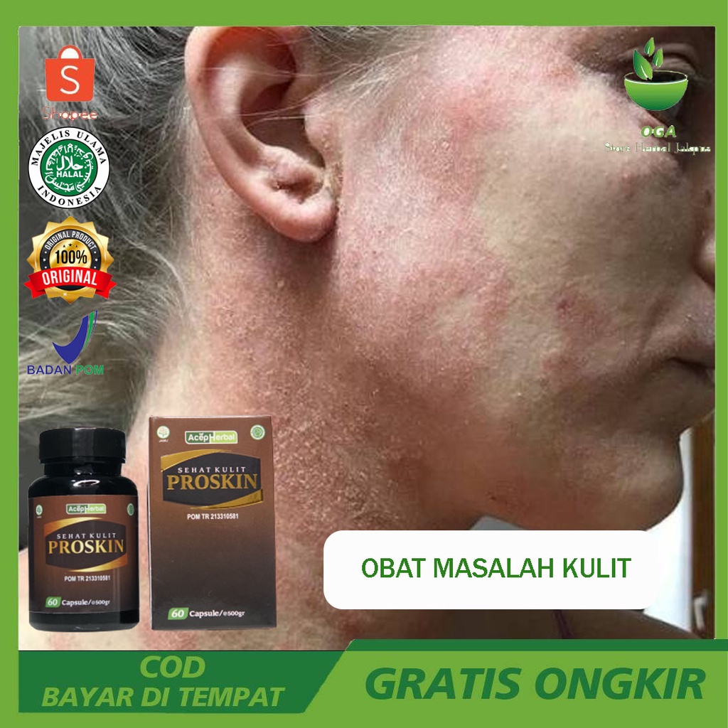 Jual Obat Masalah Kulit Pria Wanita Eksim Exim Kering Basah Menahun ...