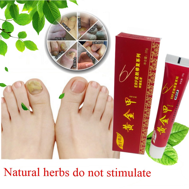Jual Chinese Medicine Plaster Nail Fungus Treatment Cream Onychomycosis ...