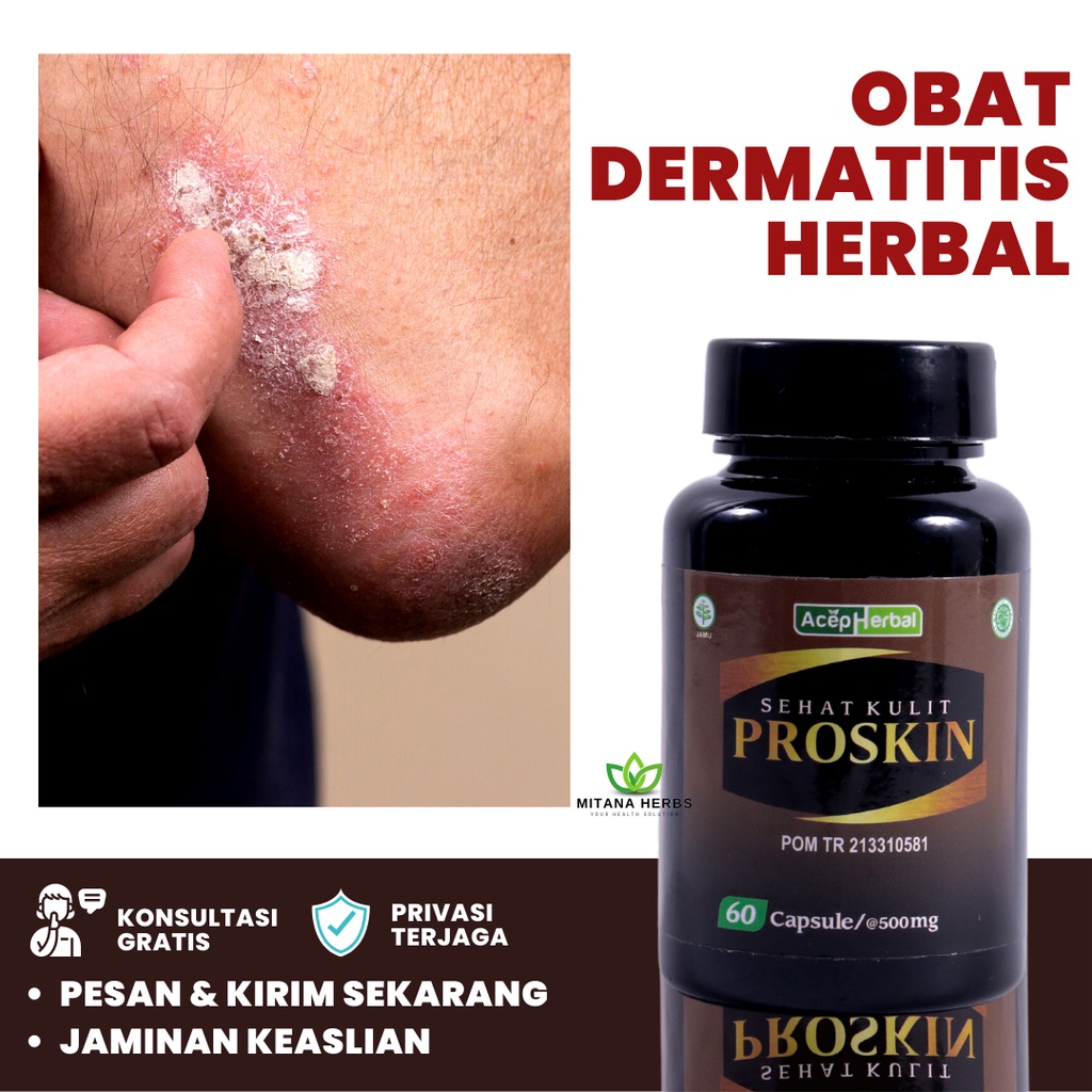 Jual Mitana Herbal - Obat Dermatitis - Dermatitis Seboroik - Dermatitis Atopik - Dermatitis ...