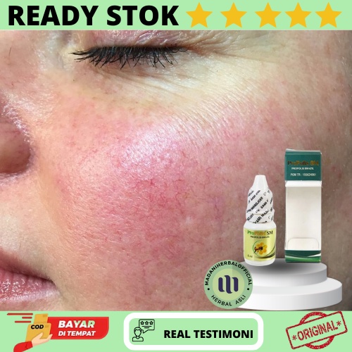 Jual Obat Spider Veins, Obat Penghilang Spider Veins | Shopee Indonesia