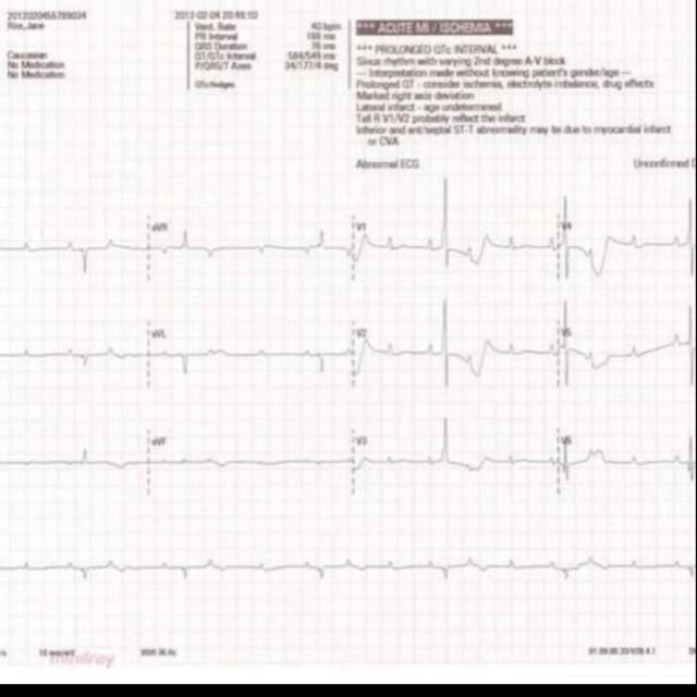 Jual Mindray R12 ECG Paper | Shopee Indonesia