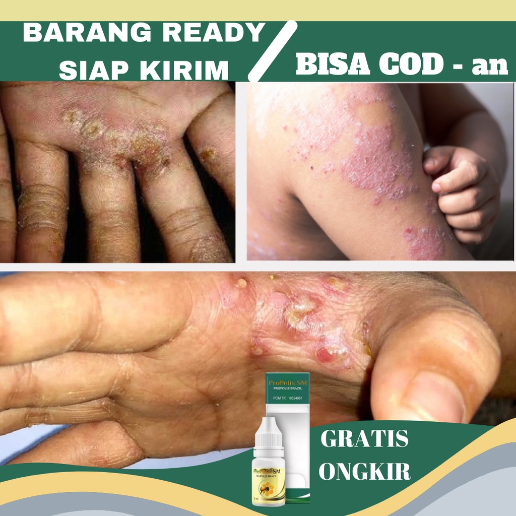 Jual Obat Gudik Bernanah, Obat Gudik Pondok, Obat Gudik Manusia, Obat ...