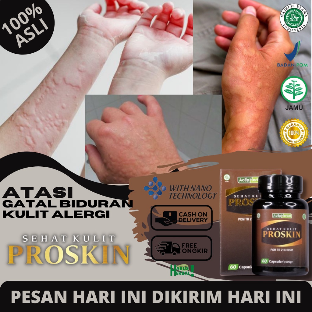 Jual Obat Biduran Gatal Alergi Dingin Menahun Obat Gatal Seluruh Badan ...
