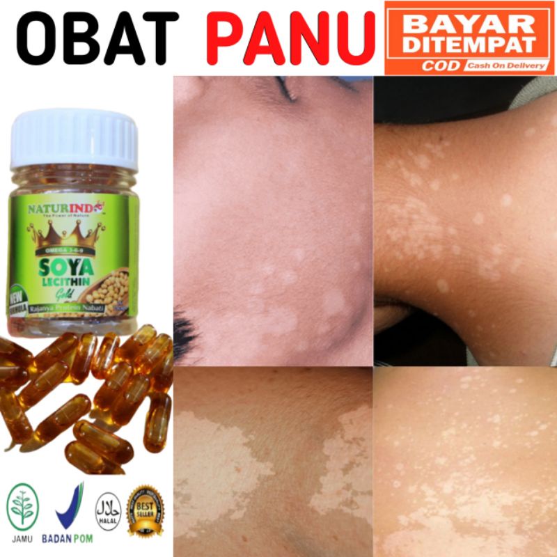 Jual Obat Panu Wajah Panu Badan Kadas Kurap Bintik Putih Kudis Bibir ...