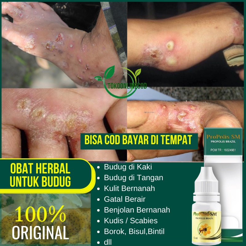 Jual Obat Untuk Budug, Kulit Bernanah, Gatal Berair, Furunkulosis, Luka ...