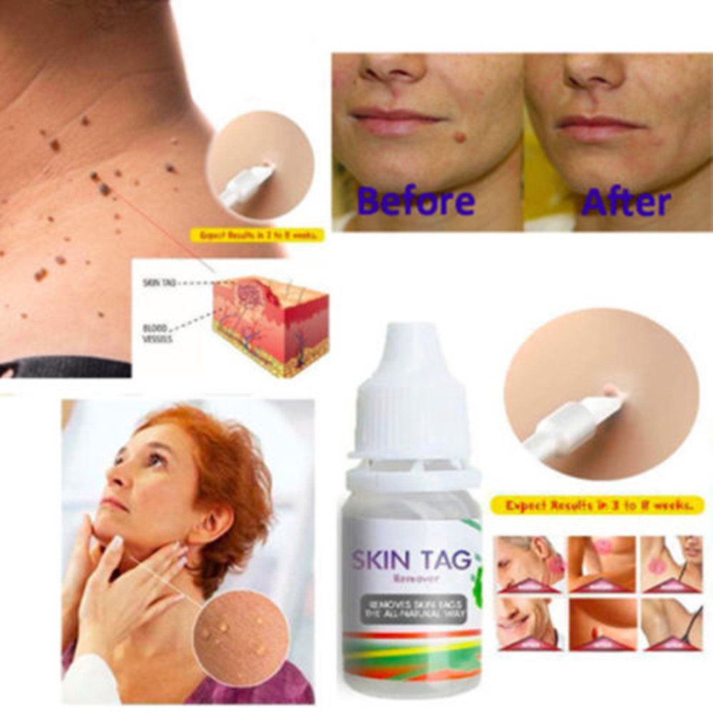 Jual Skin Tag Remover Menghilangkan Kutil Tahi Lalat Mata Ikan - Wart ...