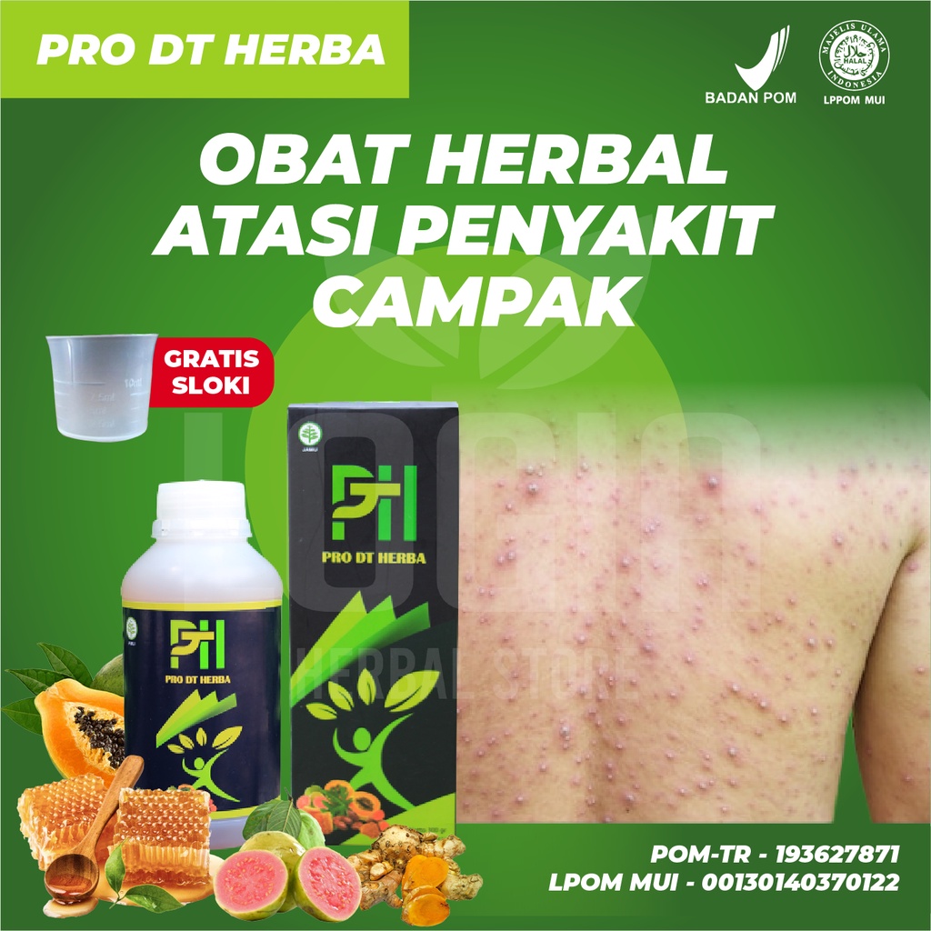 Jual Obat Campak, Obat Herbal Penyakit Campak, Gatal Ruam Kulit ...
